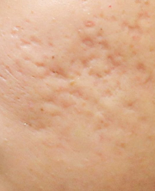 Shopping Guide - How to Clear Scars & Spots